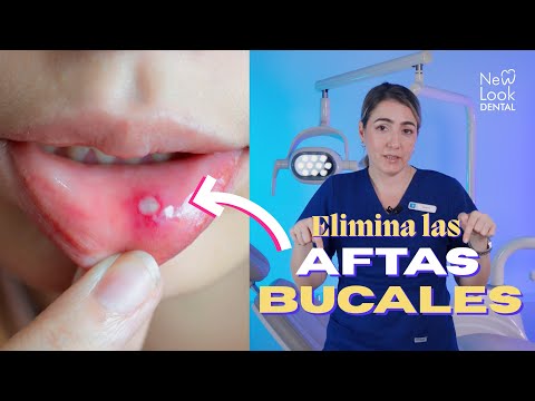 Remedios caseros efectivos para aliviar las aftas bucales - SientoSalud