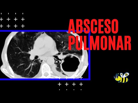 Absceso pulmonar: síntomas, causas y tratamiento efectivo