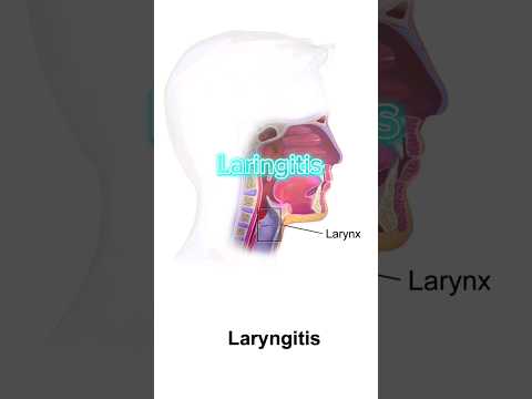 Laringofaringitis: Definición y Conceptos Clave en el Diccionario Médico