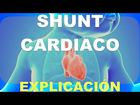 ¿Qué es Shunt? Definición y Usos en el Diccionario Médico