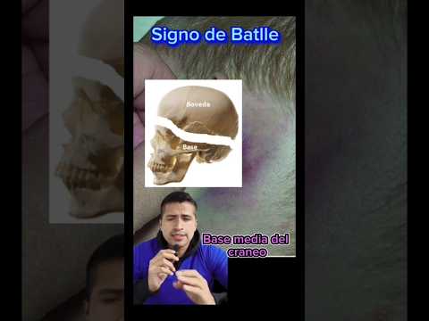 Signo de Battle: Definición y Explicación en el Diccionario Médico ...