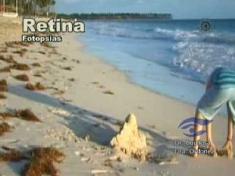 Fotopsia: Definición y Significado Médico en la Clínica