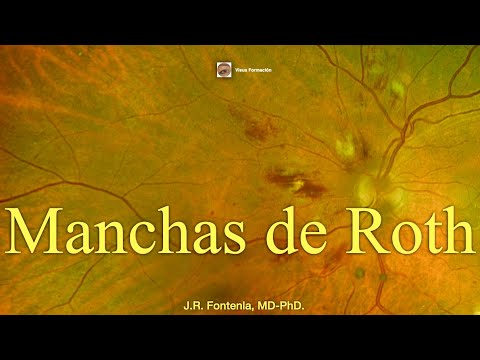 Mancha de Roth en Medicina: Definición y Significado Clínico - SientoSalud