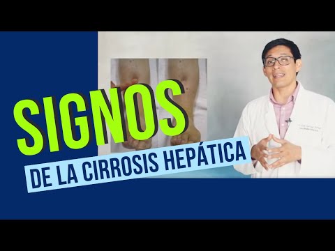 Síntomas y Complicaciones de la Cirrosis Hepática: Lo Que Necesitas Saber
