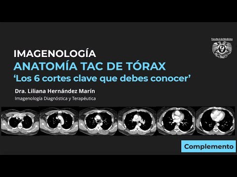 Tórax en Tonel: Definición y Conceptos Clave en el Diccionario Médico