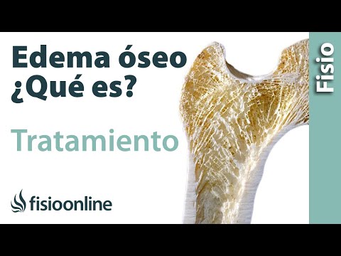 Edemas: Tipos, Causas, Síntomas y Opciones de Tratamiento Efectivas