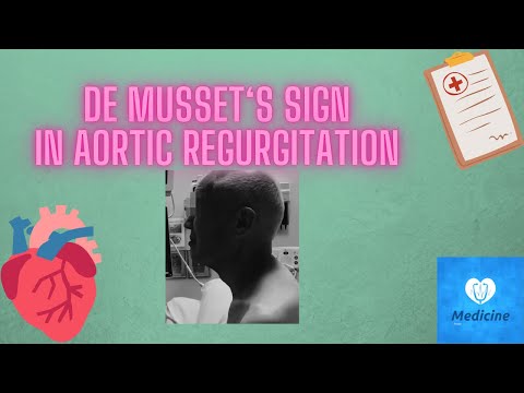 Signo de Musset: Significado y Relevancia en la Evaluación Médica