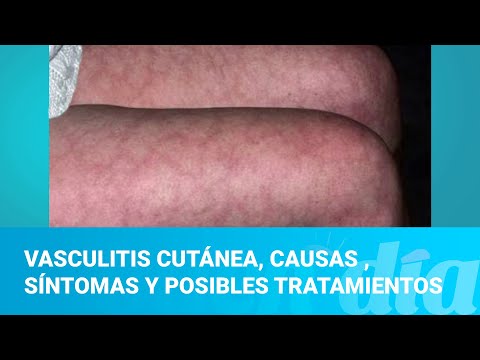 Diagnóstico de la necrosis cutánea: síntomas, causas y procedimientos ...