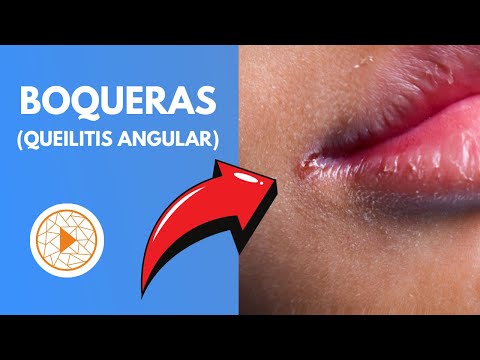 Qué es la queilitis angular y su tratamiento en la Clínica U ...