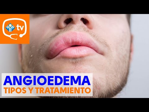 Causas y síntomas del edema de Quincke: comprensión y prevención de ...
