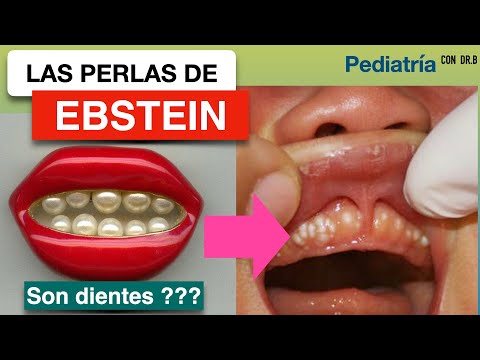 Perla de Epstein: Definición y Relevancia en el Diccionario Médico ...