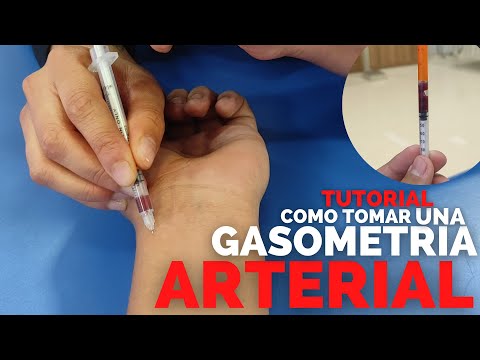 Cuándo se Realiza una Gasometría Arterial y su Importancia en Pruebas ...