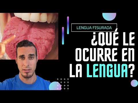 Causas y Tratamientos de la Lengua Agrietada o Fisurada