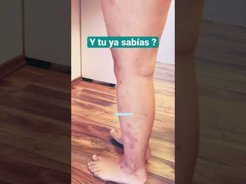 Causas y tratamiento de las manchas rojas en las piernas