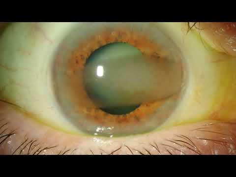 Leucoma: Definición y Tratamiento en la Clínica Médica