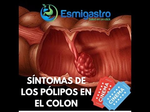 Pólipos de colon y su relación con el riesgo de cáncer: información ...
