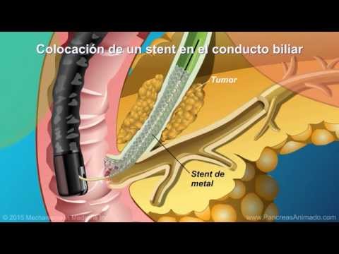 Colangiopancreatografía Retrógrada Endoscópica: Procedimiento y ...