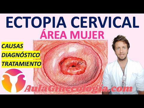 Ectopia cervical: Definición y términos clave en el diccionario médico