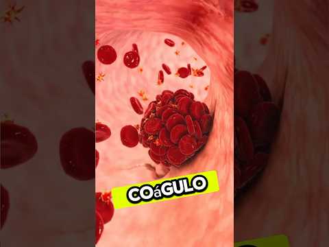 Émbolo en Medicina: Definición y Aplicaciones en el Ámbito Clínico