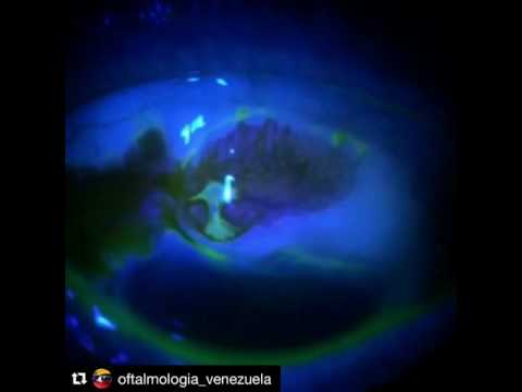 Signo de Seidel: Importancia y Significado en Oftalmología