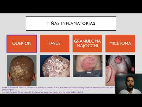 Qué es Querion de Celso y su significado en el diccionario médico