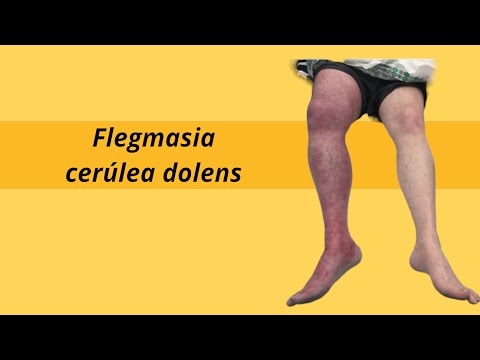 Flegmasia Alba Dolens: Definición y Conceptos Clave en el Diccionario ...