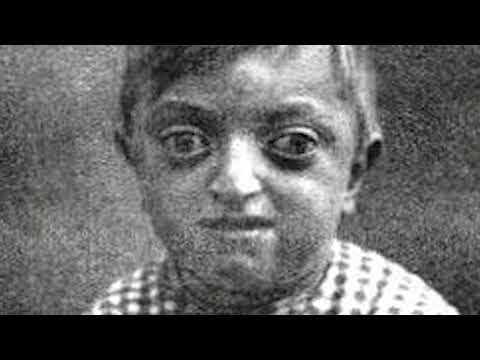 Síndrome de Crouzon: Características, Causas y Tratamientos Disponibles