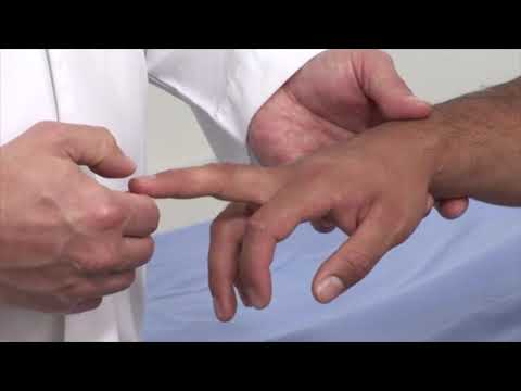 Significado y características del signo de boca de mina de Hoffmann en ...