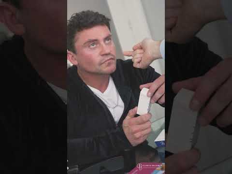 ¿Qué es la técnica de Millard y cuáles son sus aplicaciones en cirugía ...